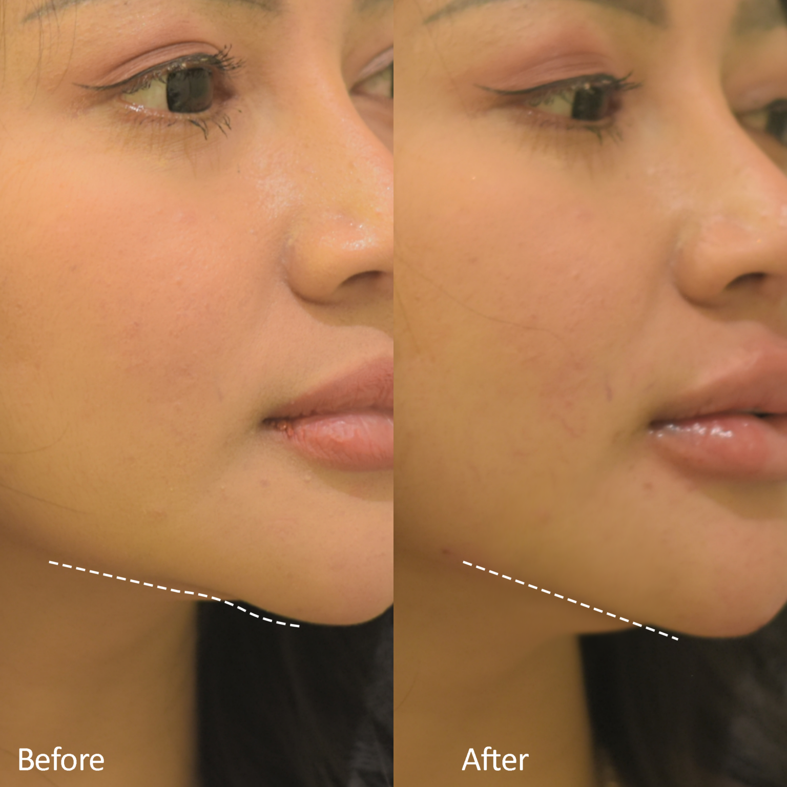 Sculpted Jawline dengan Jawline Filler - Insta Beauty Center