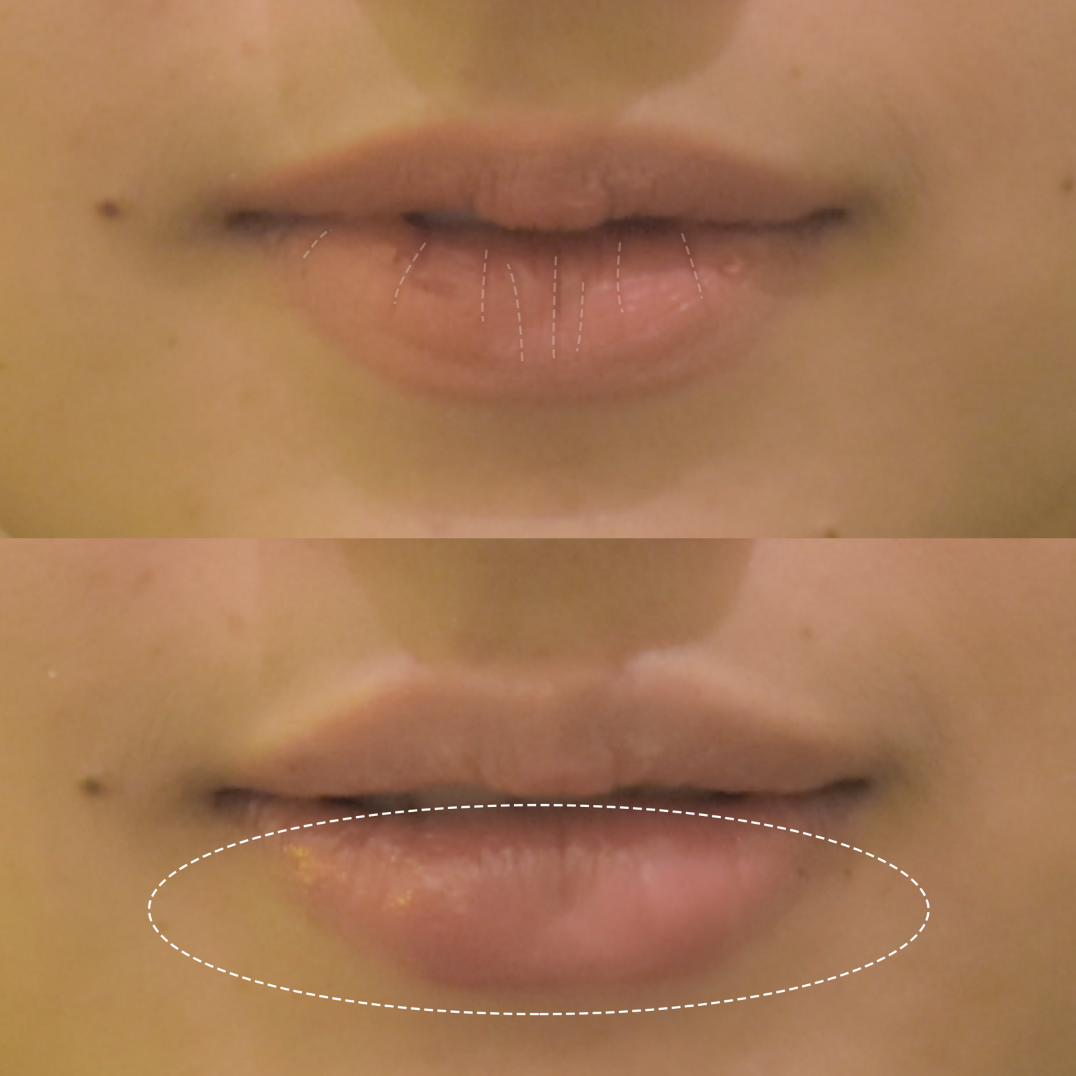 5 Hal yang Perlu Anda Tahu Sebelum Memutuskan Lip Filler - Insta Beauty ...